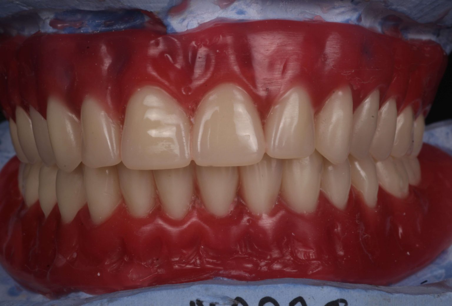 Dentures – Grooves Dental Deisgn